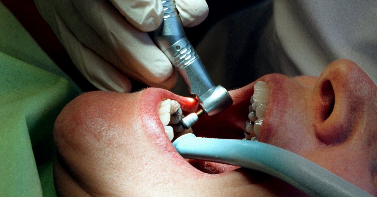 Tandläkarstudent i Umeå borrade sönder partners tand | SVT Nyheter