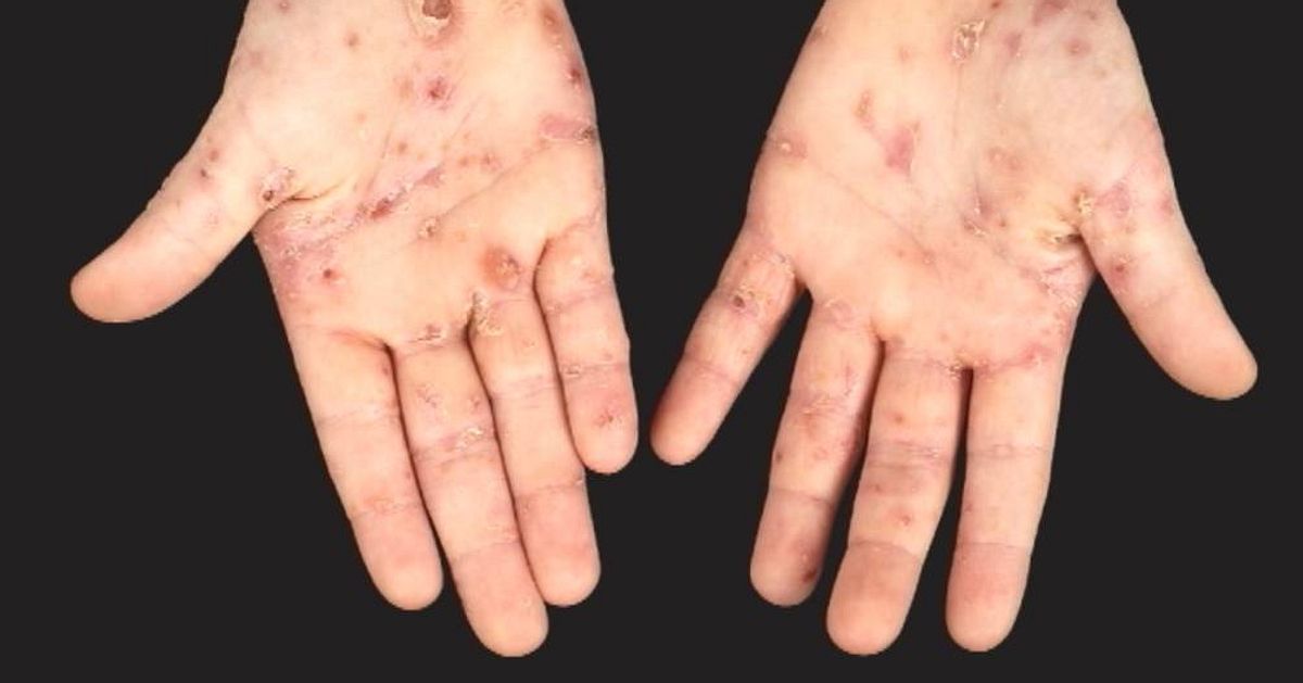 Flera fall av skabb bland unga upptäckta i Mellerud | SVT Nyheter