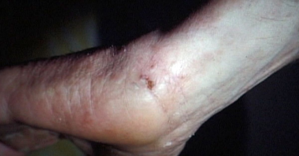 Misstänkt skabb på skola | SVT Nyheter