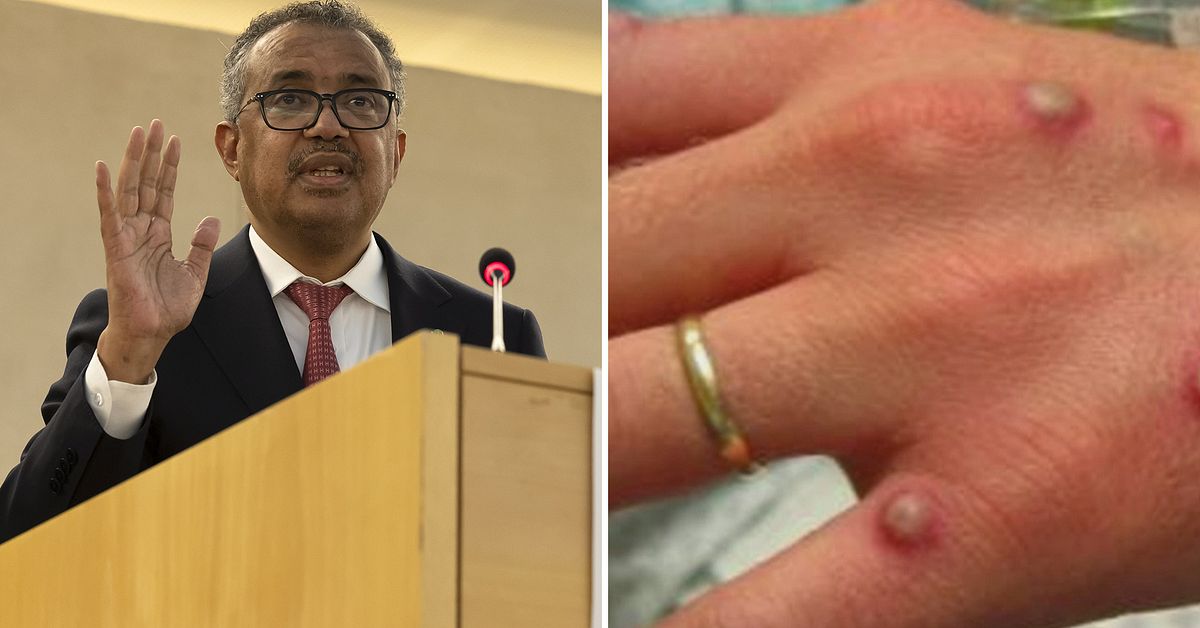 WHO: Massvaccination mot apkoppor är inte nödvändig | SVT Nyheter