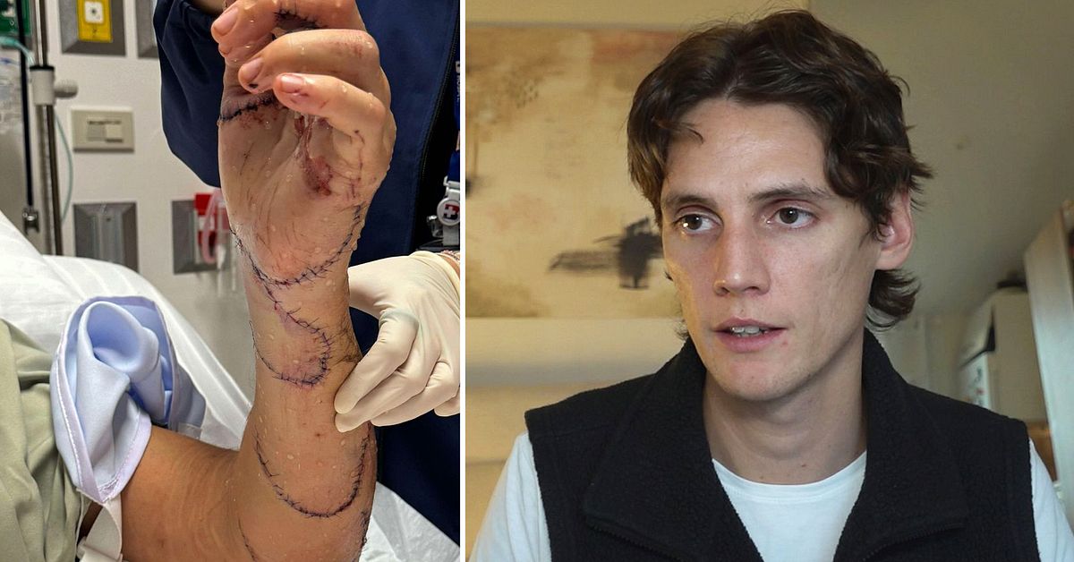 Båtolyckan i Thailand trasade sönder Emanuels arm: ”Trodde jag skulle ...