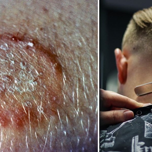 Smittskyddsläkaren: Svampsmitta sprids bland unga män i Norrköping ...