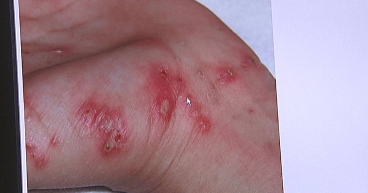 Skabb sprids bland elever på skolor i Piteå | SVT Nyheter