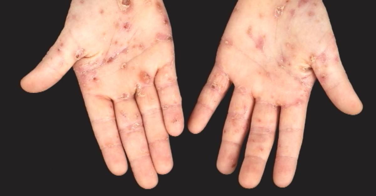 Kraftig ökning av skabb | SVT Nyheter