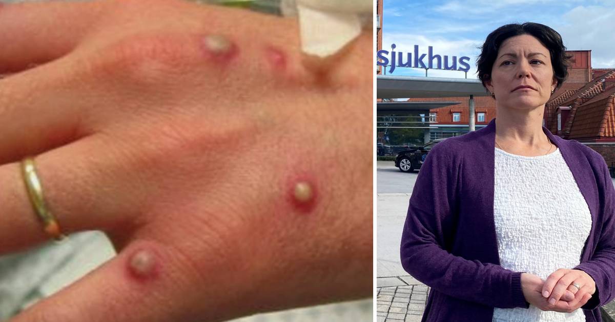 Bekräftat fall av apkoppor i Halland | SVT Nyheter