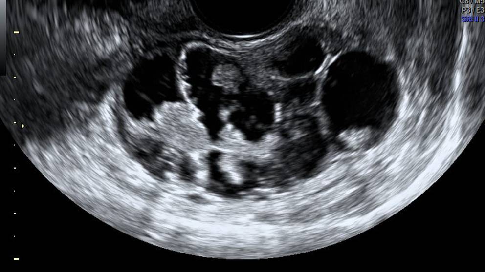 Ofta onödigt att operera äggstockar | SVT Nyheter