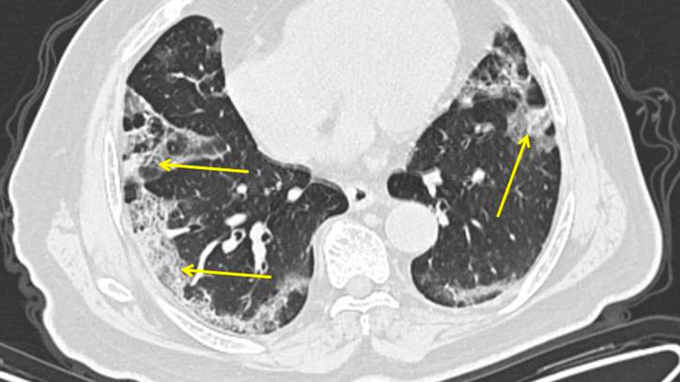 Omfattande förändringar i lungorna hos svårt sjuka coronapatienter ...